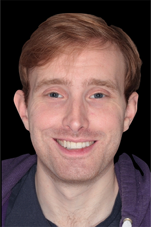 Tooth-coloured fillings in London | Discreet fillings at Fresh Dental ...