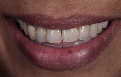 Invisalign in London | Invisalign teeth straightening at Fresh Dental ...