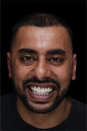 Tooth-coloured fillings in London | Discreet fillings at Fresh Dental ...