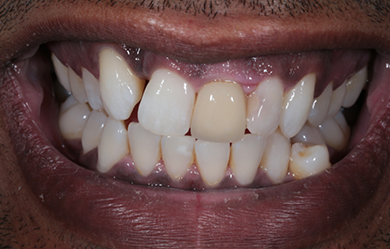 Tooth-coloured fillings in London | Discreet fillings at Fresh Dental ...