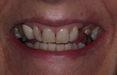 Dental implants in London | Fix and replace your teeth with dental ...