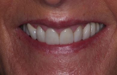 Dental implants in London | Fix and replace your teeth with dental ...