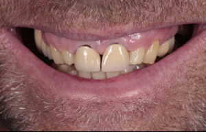 Dental implants in London | Fix and replace your teeth with dental ...