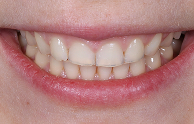 Composite bonding in London | Fix chipped teeth or broken teeth with ...