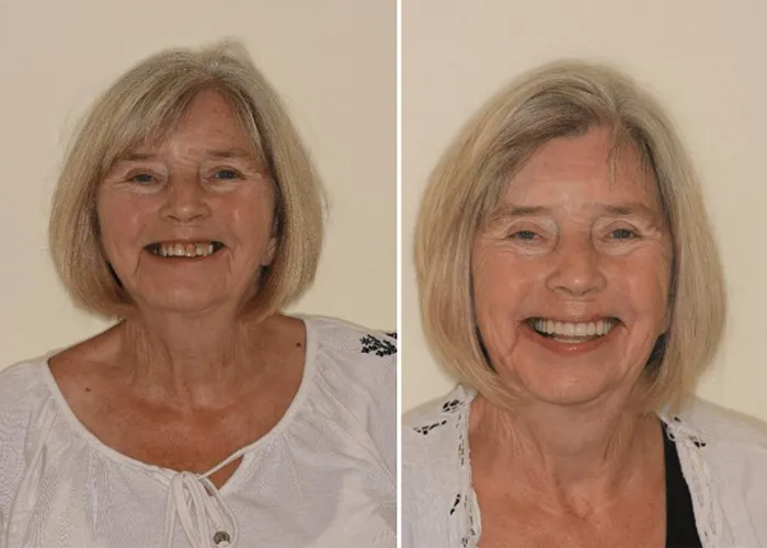 Dentist Near Me | Jolie Smiles | Smile Gallery