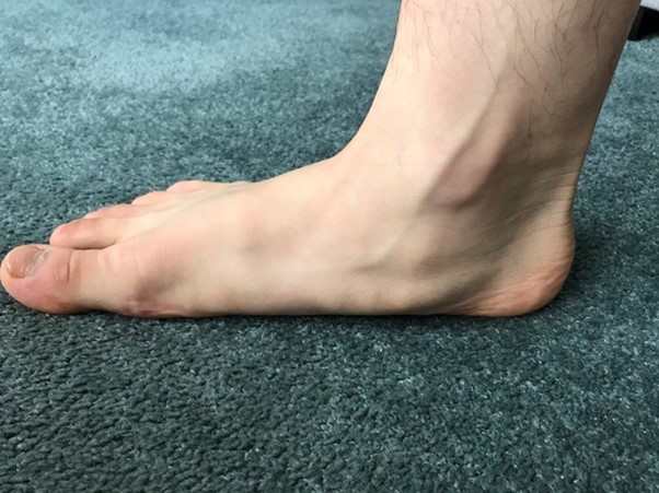 Flat feet, collapsed arches: Does it matter?