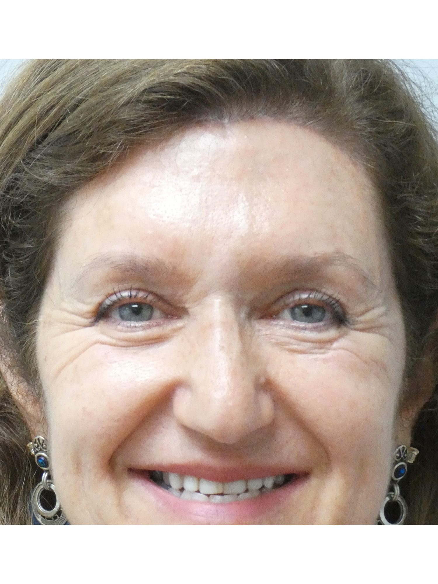 Brow Lifts / Temple Lifts | Dr. George Parras M.D.