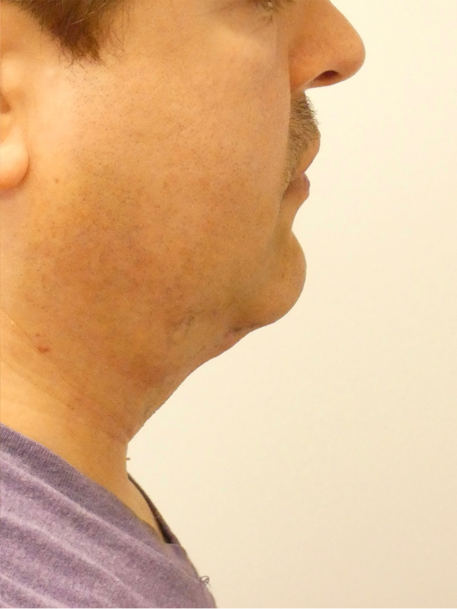 Chin Implant Surgery | Dr. George Parras M.D.