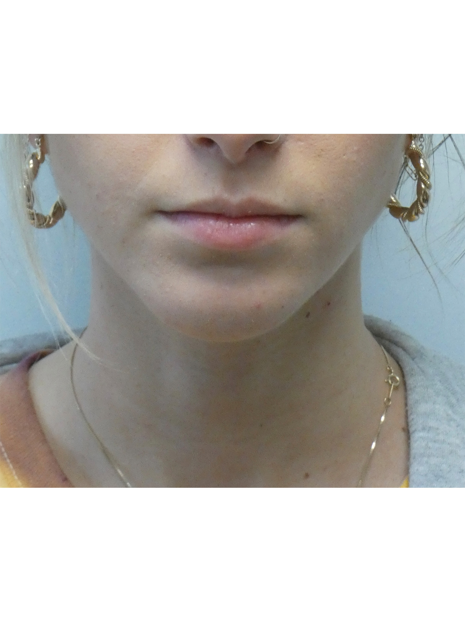 Chin Implant Surgery | Dr. George Parras M.D.