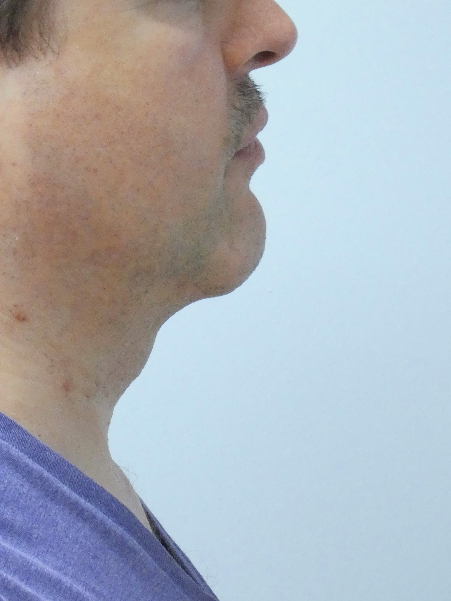 Chin Implant Surgery | Dr. George Parras M.D.