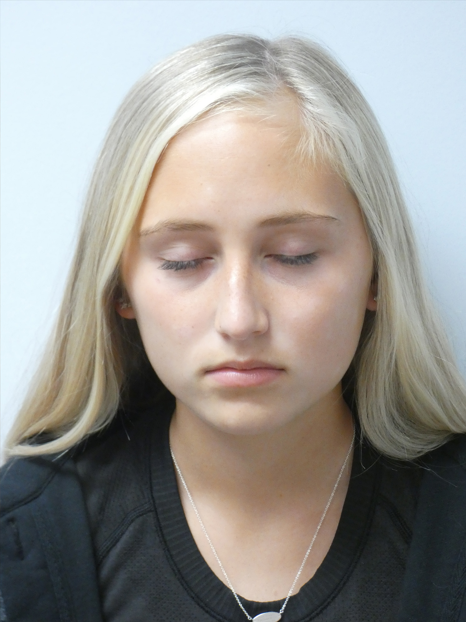 Corrective Nasal Surgery (Rhinoplasty) | Dr. George Parras M.D.