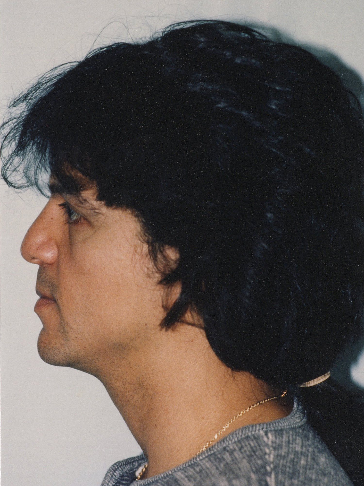 Corrective Nasal Surgery (Rhinoplasty) | Dr. George Parras M.D.