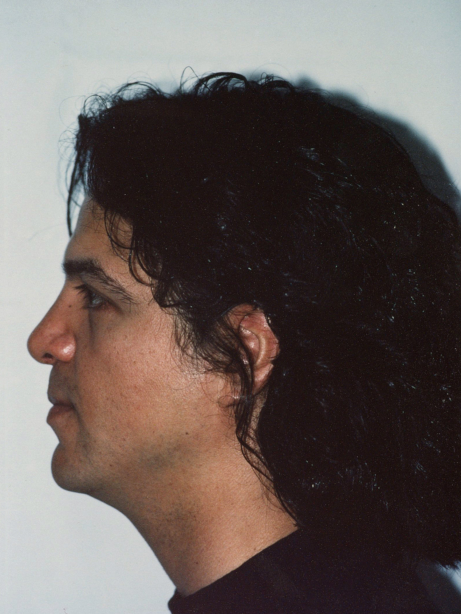 Corrective Nasal Surgery (Rhinoplasty) | Dr. George Parras M.D.