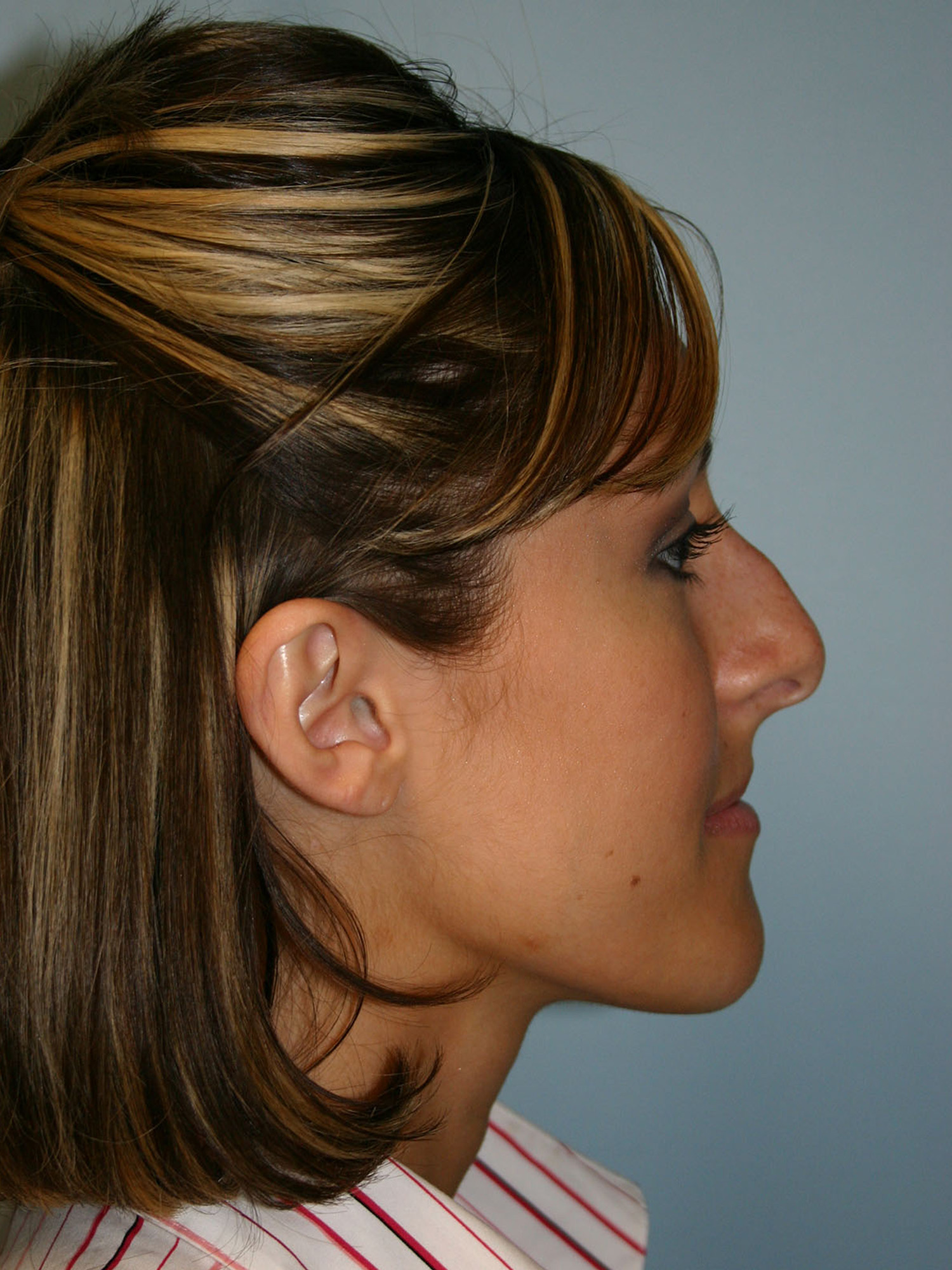 Corrective Nasal Surgery (Rhinoplasty) | Dr. George Parras M.D.