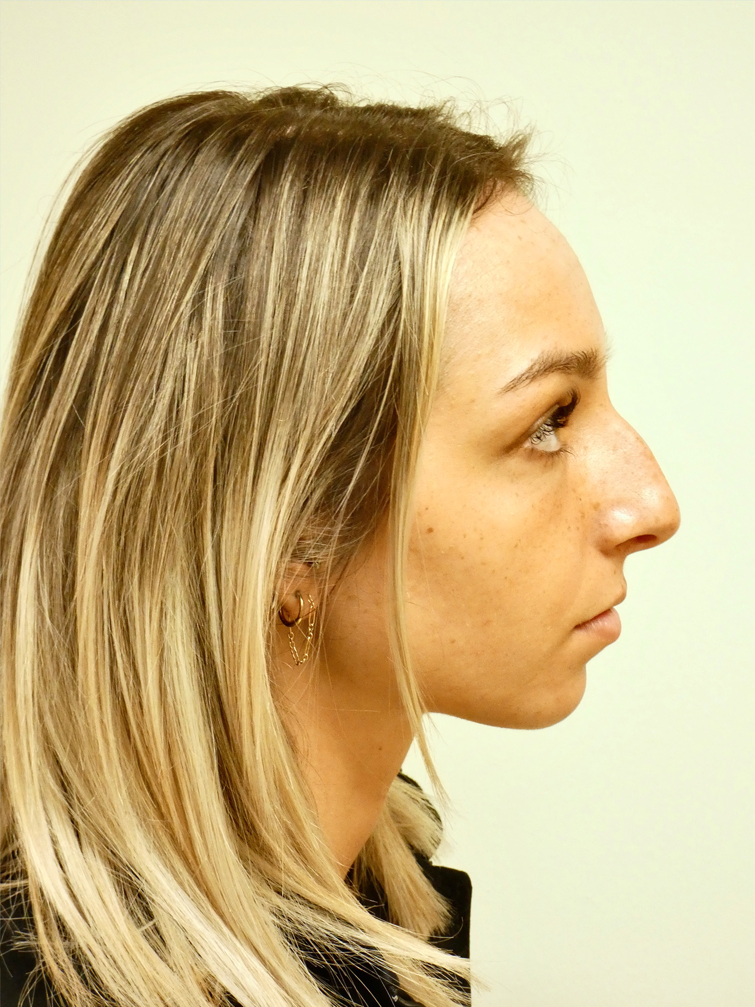 Corrective Nasal Surgery (Rhinoplasty) | Dr. George Parras M.D.