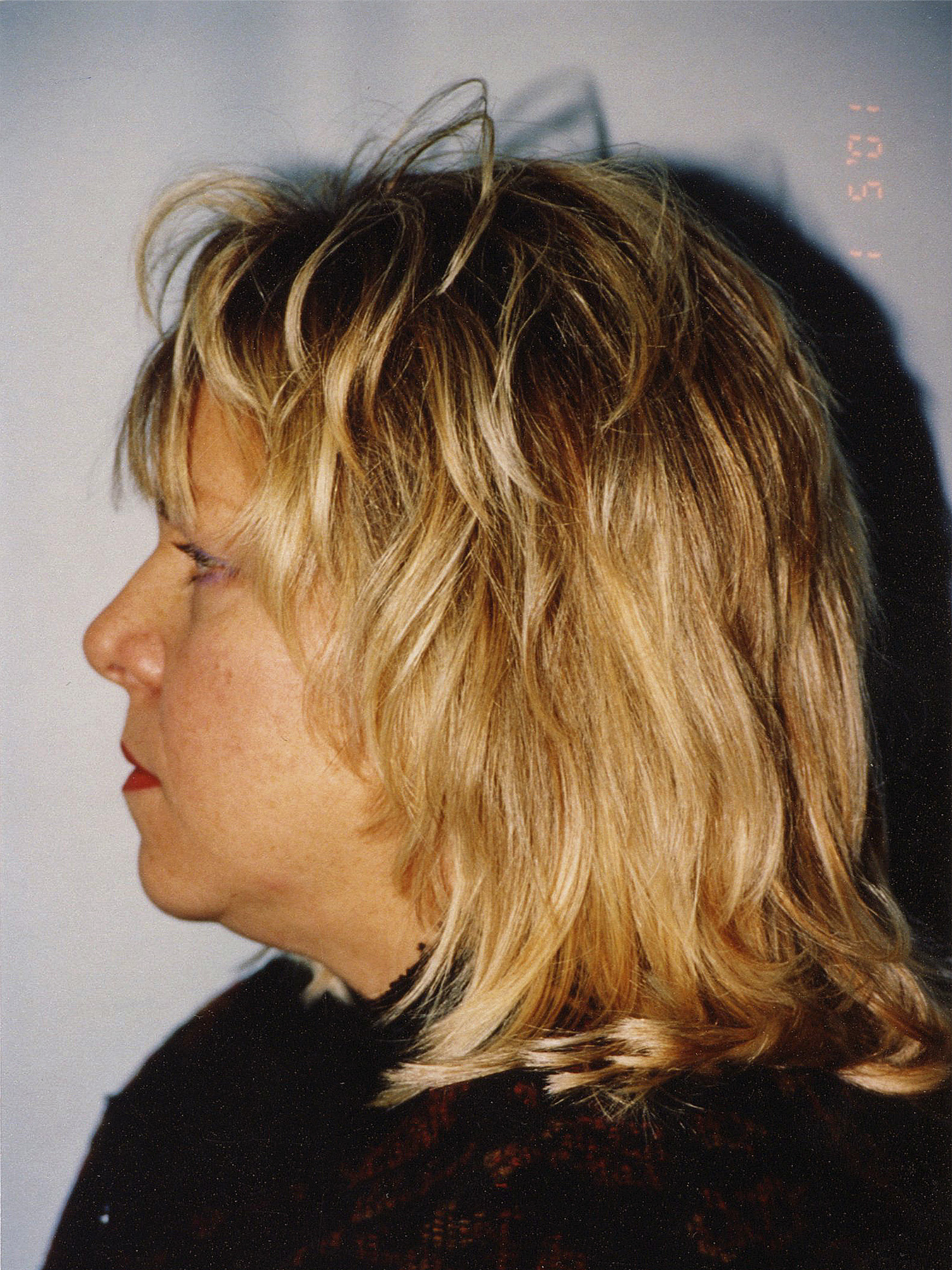 Corrective Nasal Surgery (Rhinoplasty) | Dr. George Parras M.D.