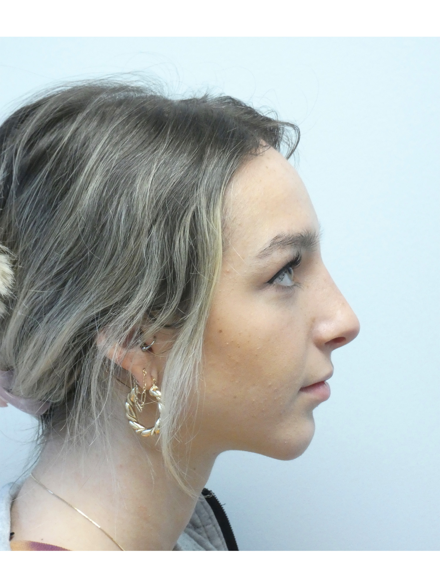 Corrective Nasal Surgery (Rhinoplasty) | Dr. George Parras M.D.