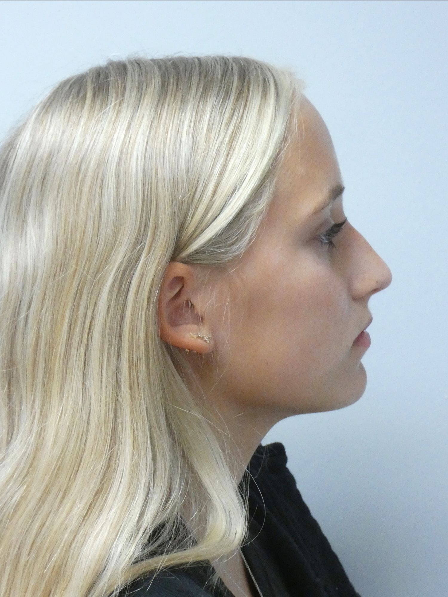 Corrective Nasal Surgery (Rhinoplasty) | Dr. George Parras M.D.