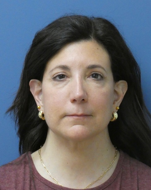 Facelift | Dr. George Parras M.D.