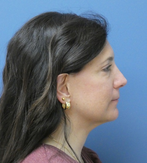 Facelift | Dr. George Parras M.D.