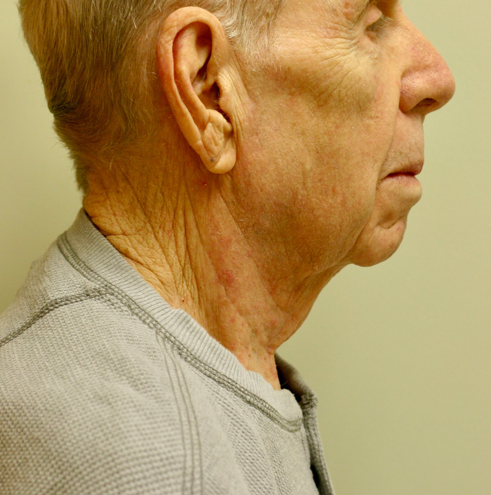 Direct Excision Neck Lift | Dr. George Parras M.D.