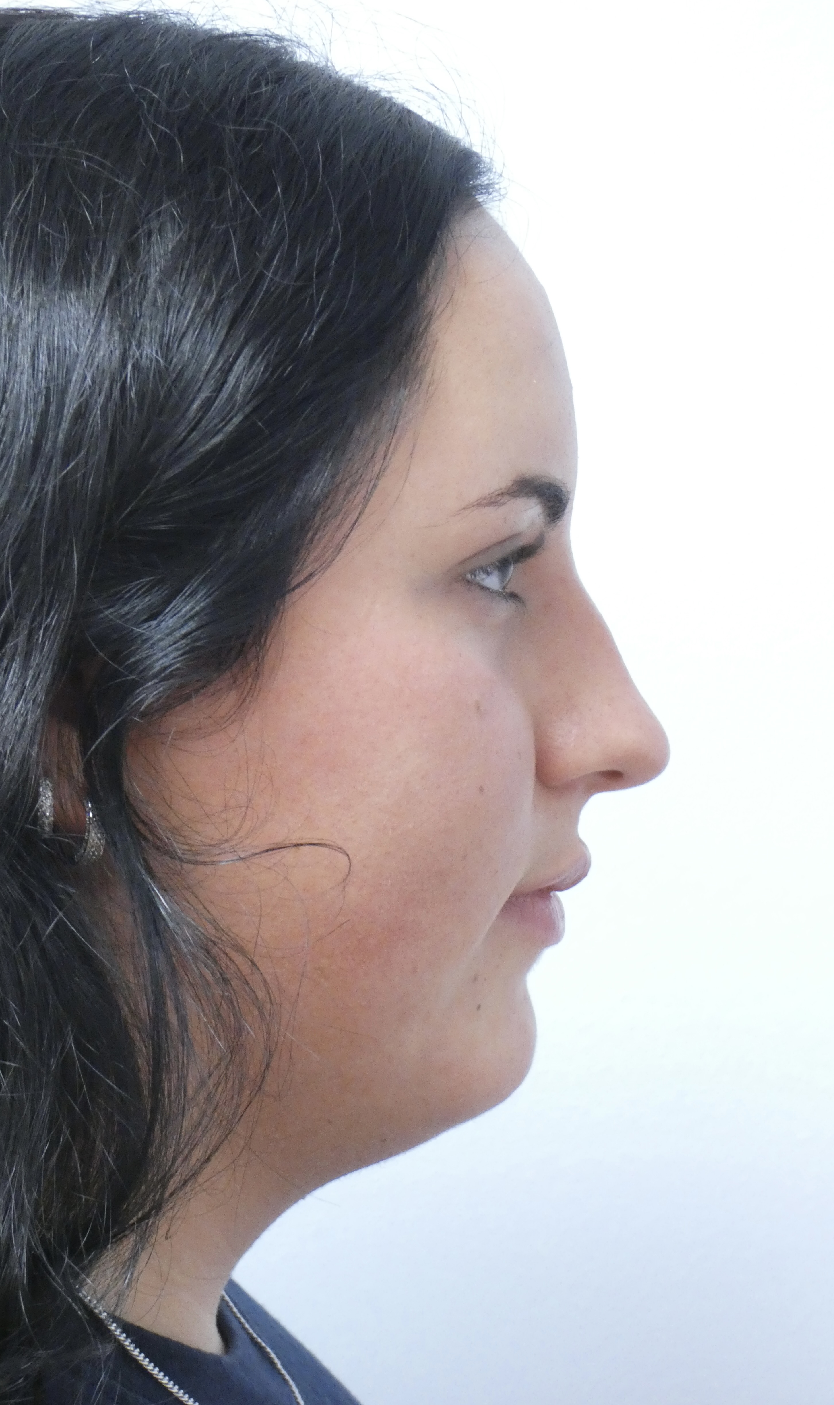 Chin Implant Surgery | Dr. George Parras M.D.