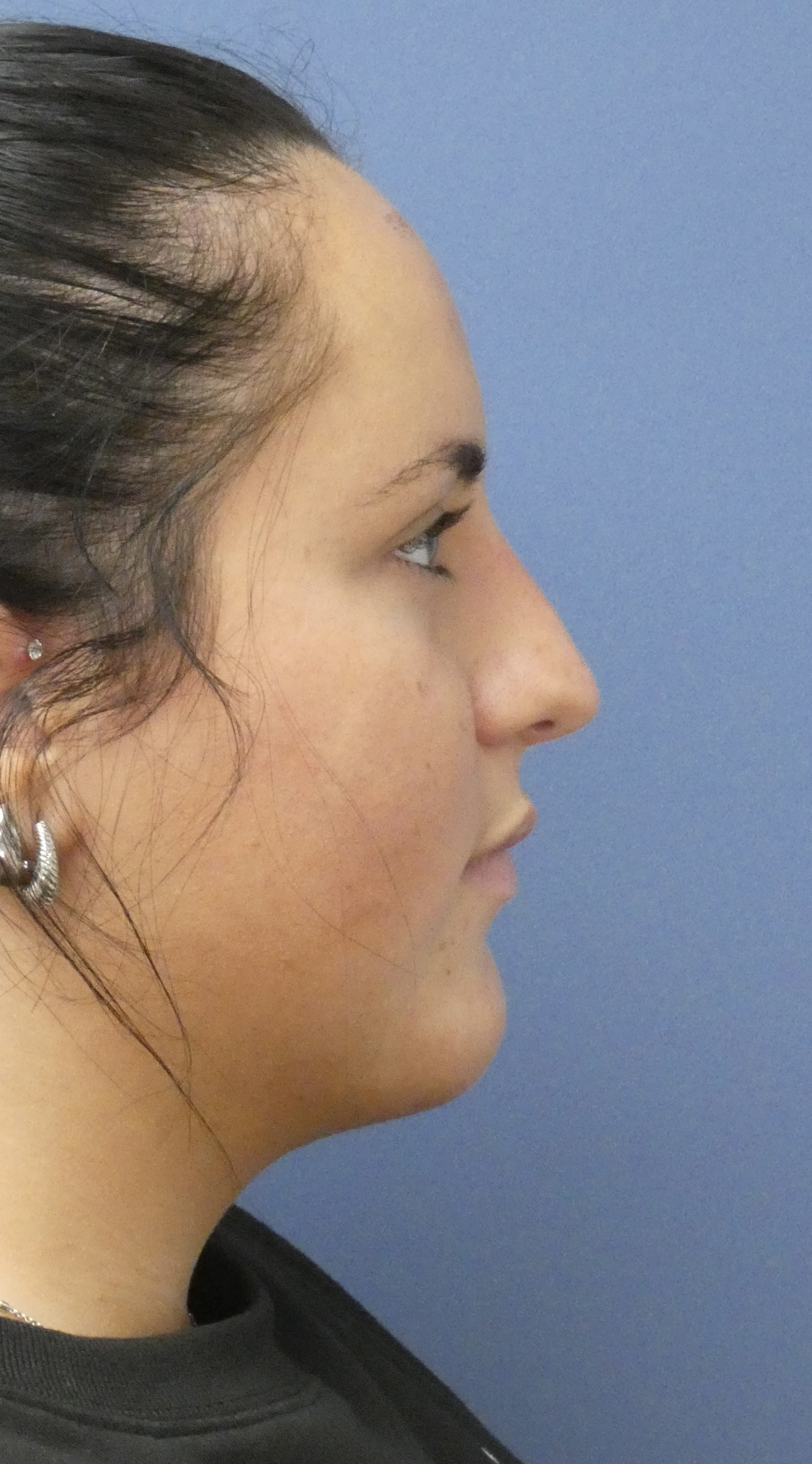 Chin Implant Surgery | Dr. George Parras M.D.