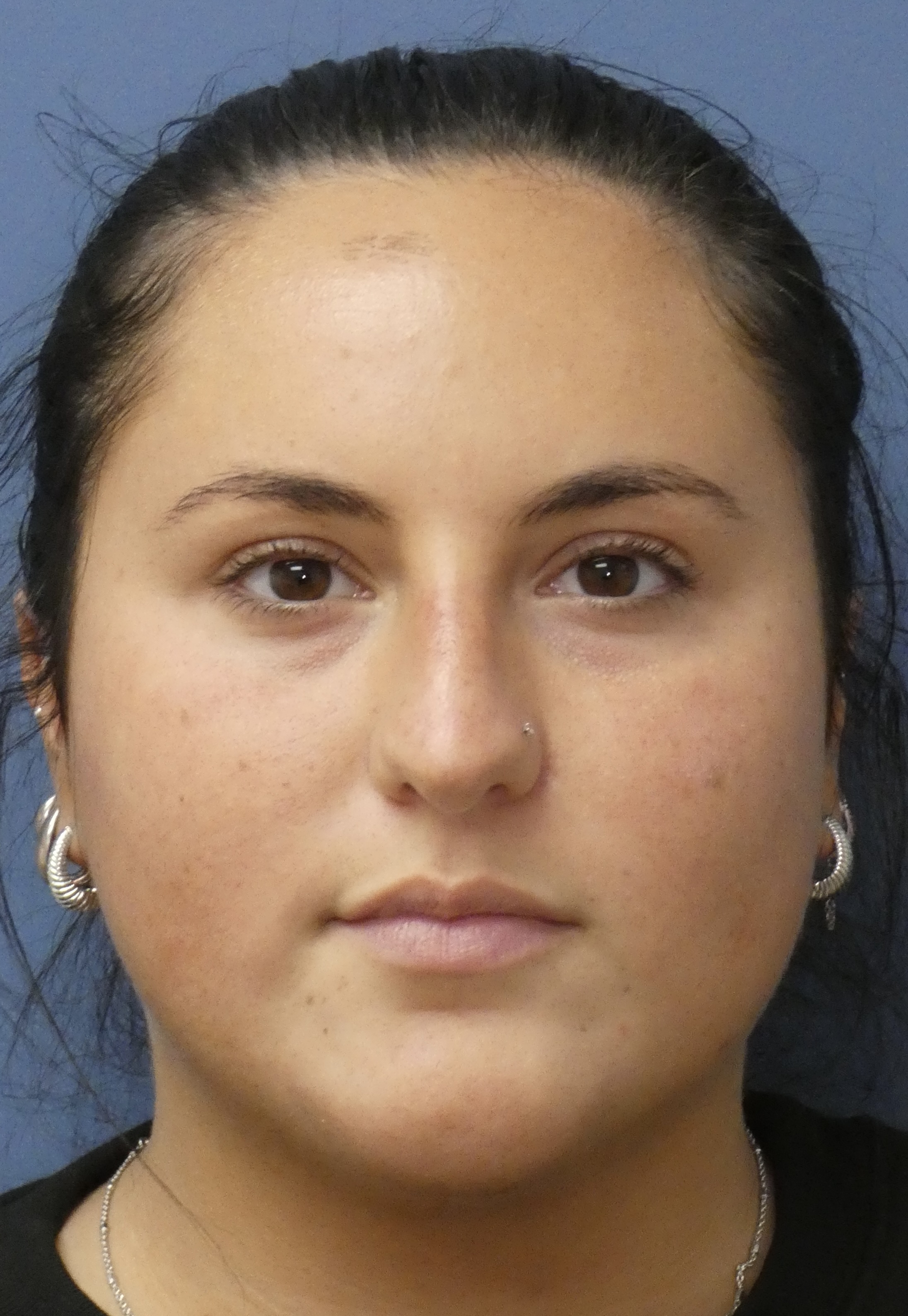 Chin Implant Surgery | Dr. George Parras M.D.