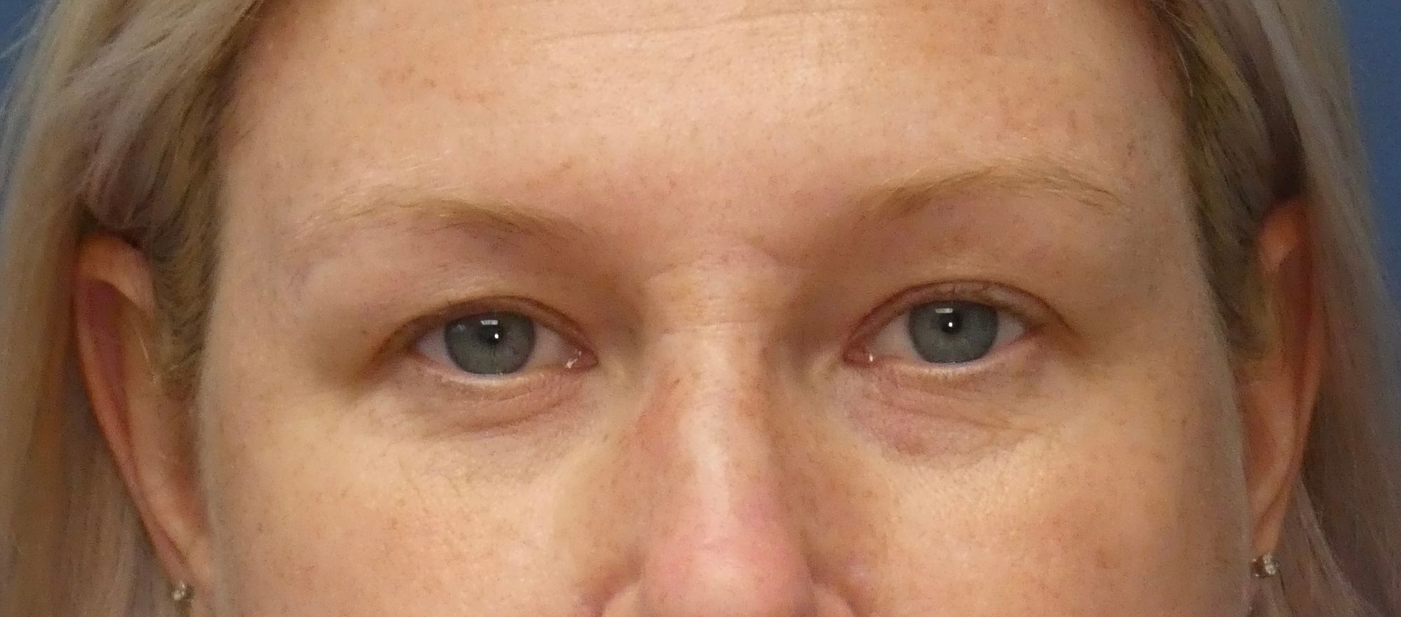 Brow Lifts / Temple Lifts | Dr. George Parras M.D.