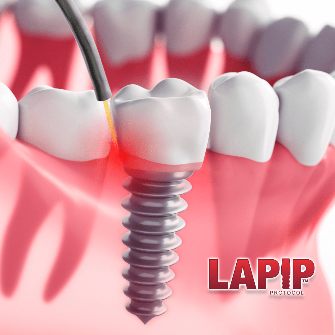 Smile Restoration: Laser Assisted Peri-Implantitis Procedure (LAPIP) in ...