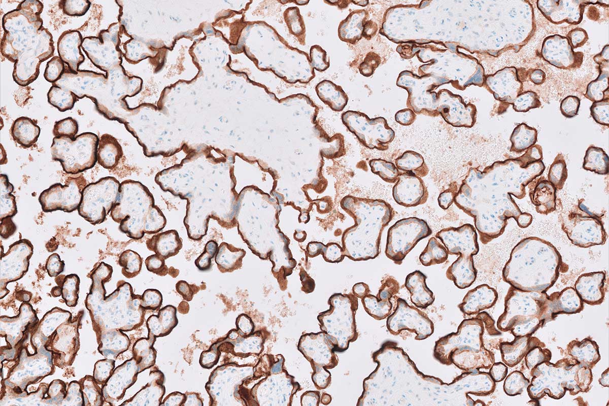 Prostate Disease - Pee Dee Pathology