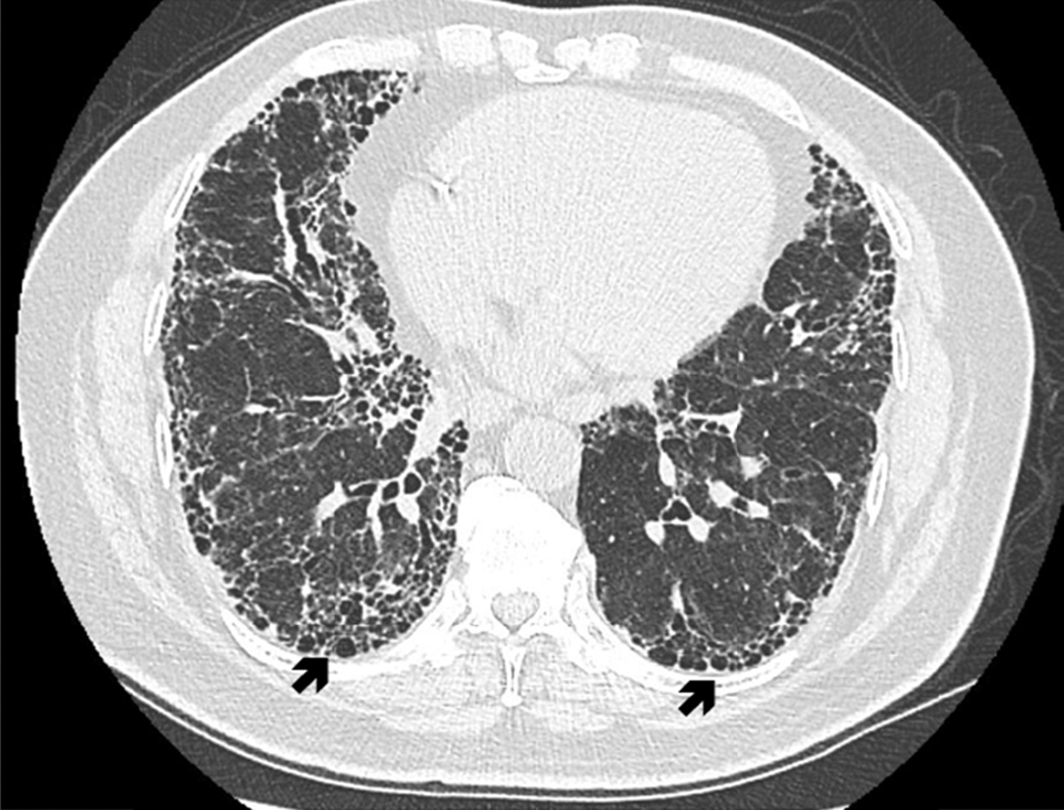 Pulmonary Fibrosis / ILD: Diagnosis, Treatment, and Support for Better ...