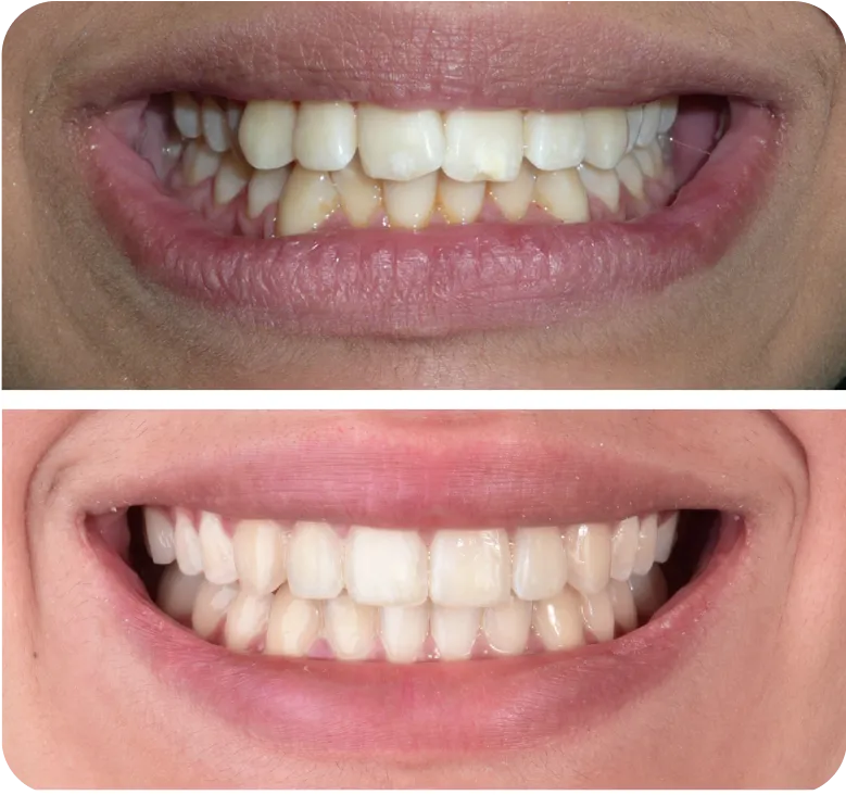 Clear aligners Before & After: Our Patients Speak For Us | Eon Aligner