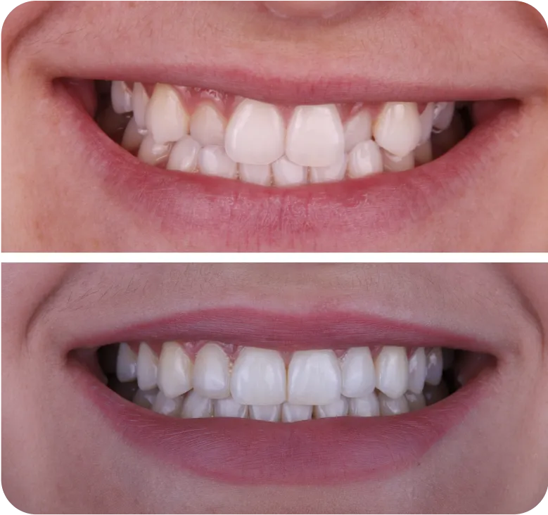 Clear aligners Before & After: Our Patients Speak For Us | Eon Aligner