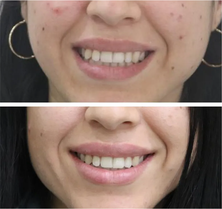 Clear aligners Before & After: Our Patients Speak For Us | Eon Aligner