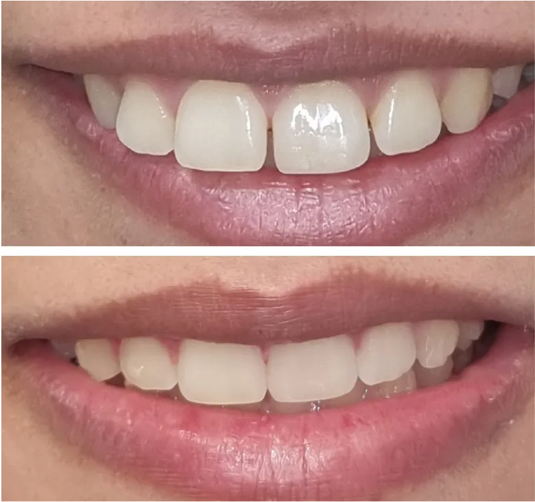 Clear aligners Before & After: Our Patients Speak For Us | Eon Aligner
