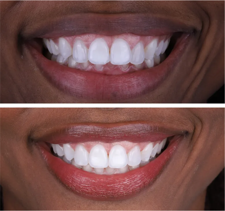 Clear aligners Before & After: Our Patients Speak For Us | Eon Aligner