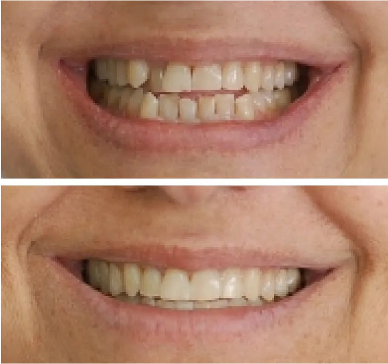 Clear aligners Before & After: Our Patients Speak For Us | Eon Aligner