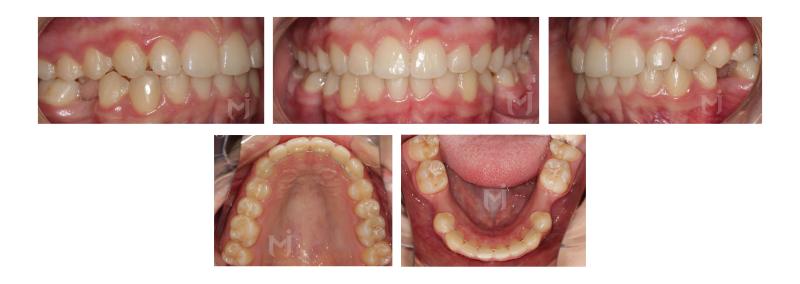 Deep Bite Correction with Aligners: Case Study & Results