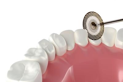 What is Enameloplasty? When & How to Perform this Procedure