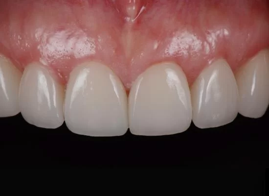 IPR in Aligners: Procedure, Benefits (and much more)