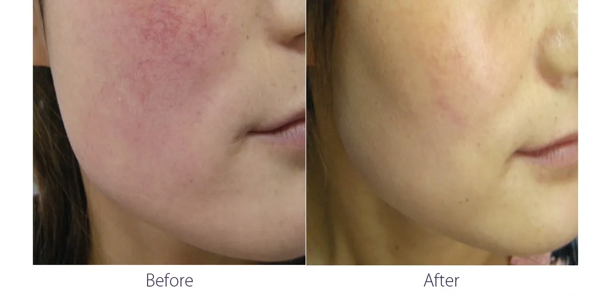 DYE VL for Vascular Lesions, Sun Damage, & Rosacea