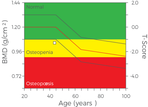 Bone Density Scanning | Helping Osteoporosis Diagnostics