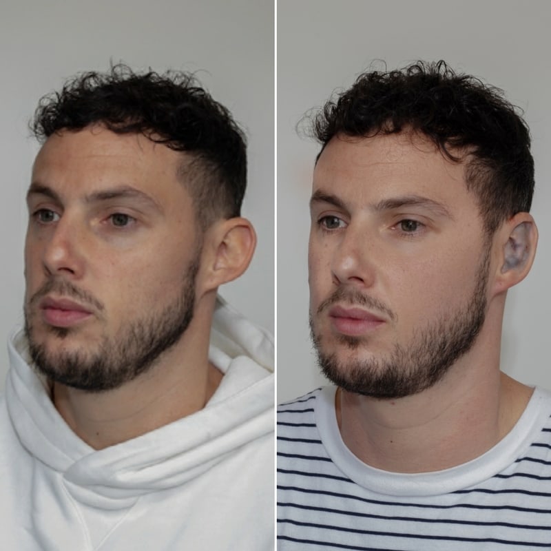 Suture Otoplasty for Ears | GMC Cosmedical