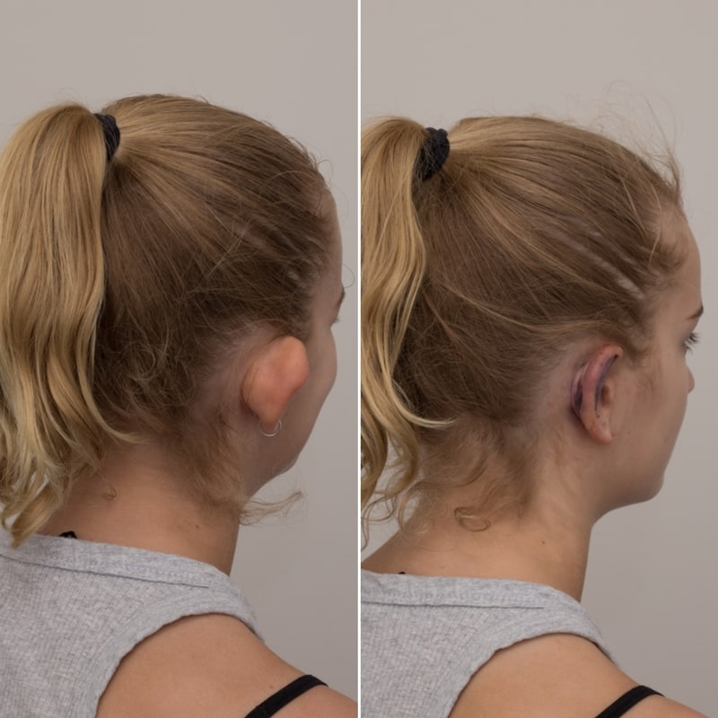 Suture Otoplasty for Ears | GMC Cosmedical