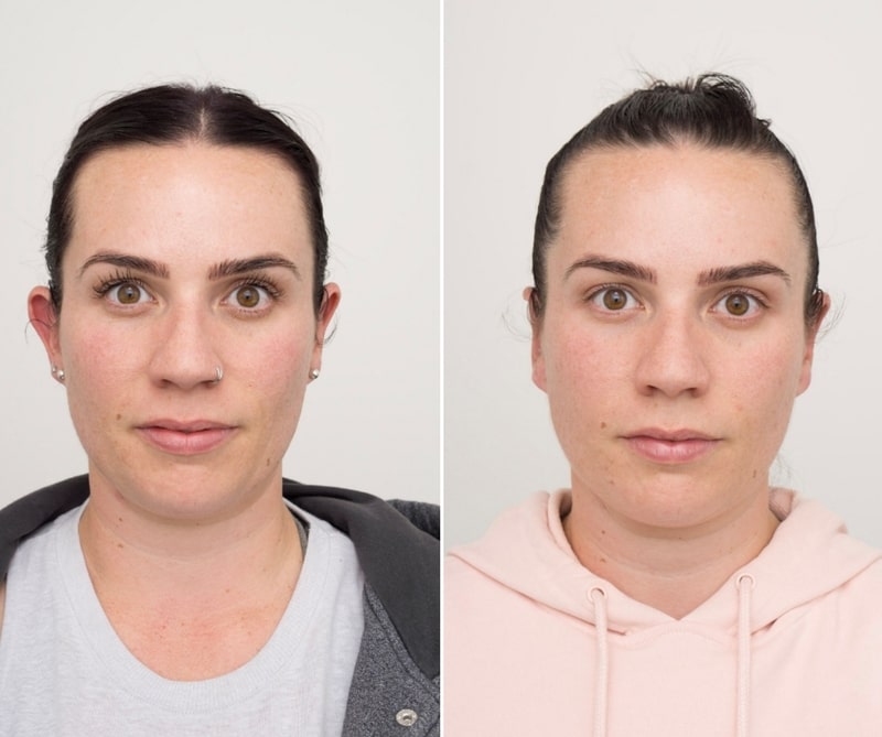 Suture Otoplasty Ear Correction | GMC Cosmedical