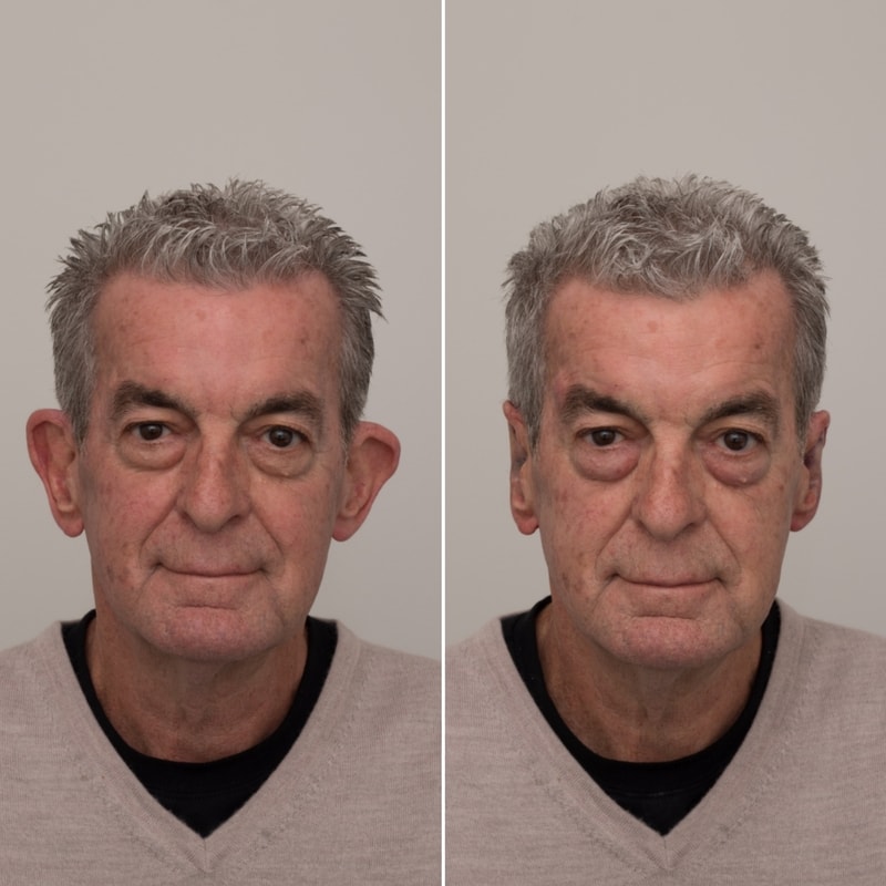 Suture Otoplasty for Ears | GMC Cosmedical