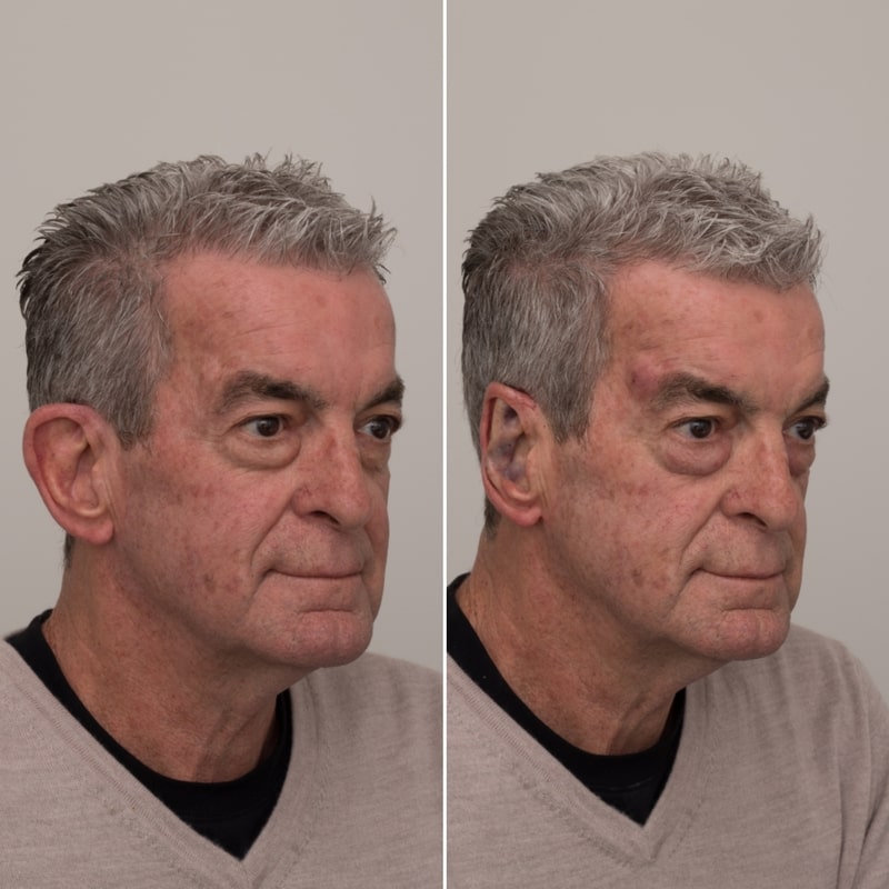 Suture Otoplasty for Ears | GMC Cosmedical