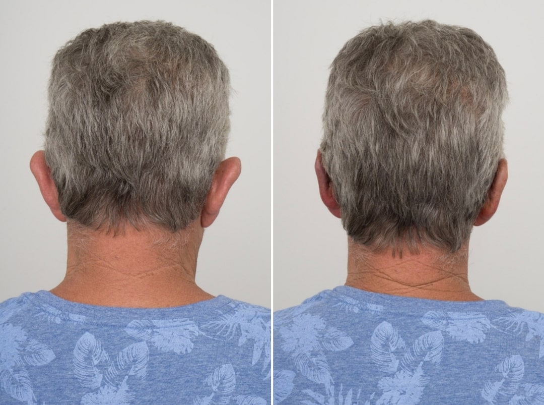 Suture Otoplasty for Ears | GMC Cosmedical