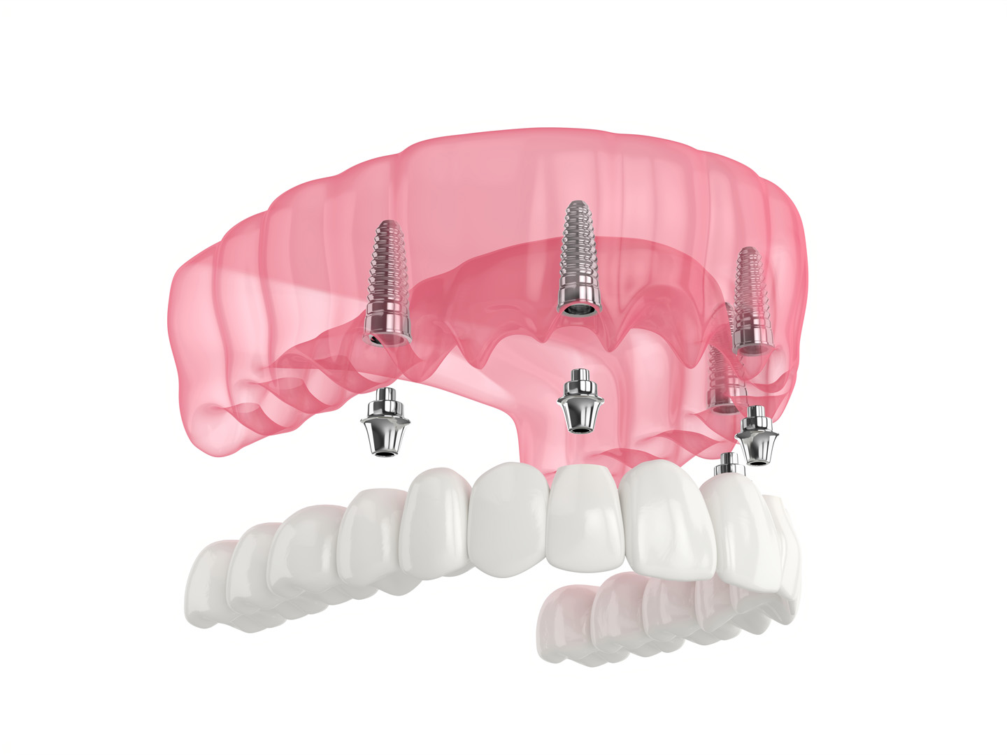 All-on-X Dental Implants in Hampton | Hampton Oral & Facial Surgery